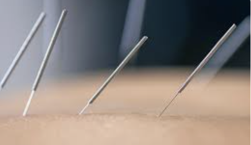 What Is Dry Needling and How Does It Help? | Domier Chiropractic
